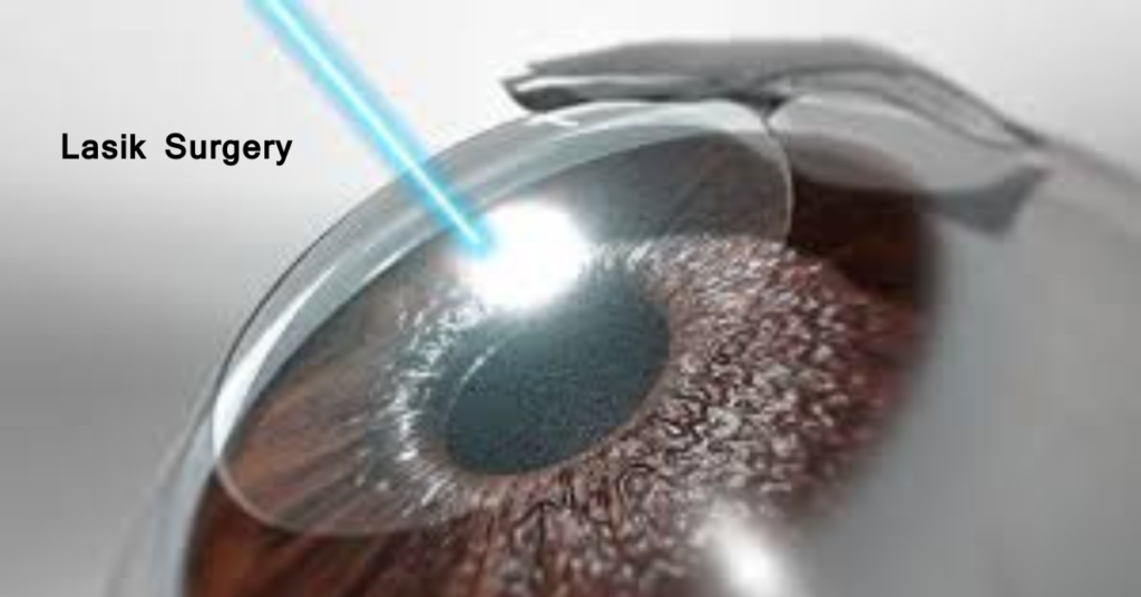 LASIK Surgery: Correct Your Vision